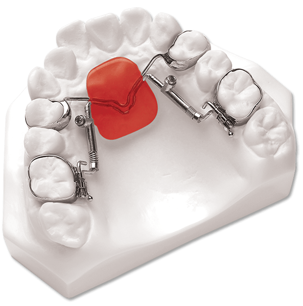 Distalizers - DynaFlex