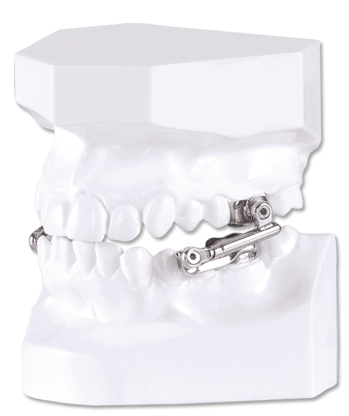 Herbst Orthodontic Appliance - DynaFlex