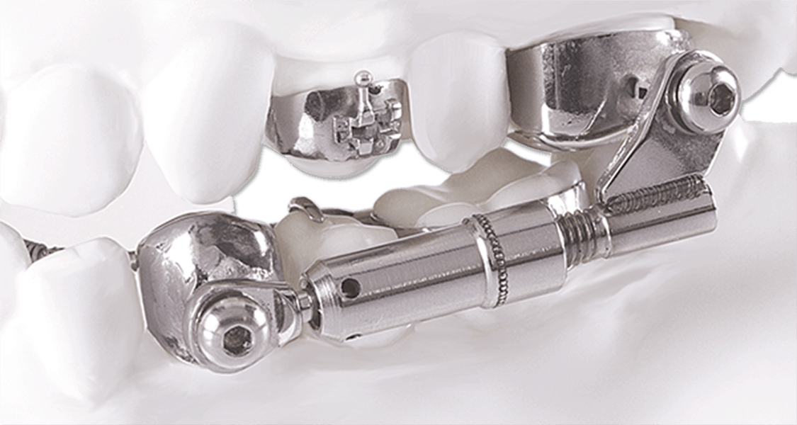 Herbst Orthodontic Appliance - DynaFlex