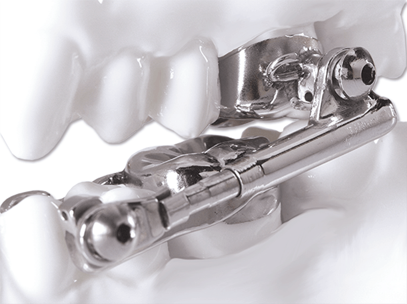 Herbst Orthodontic Appliance - DynaFlex