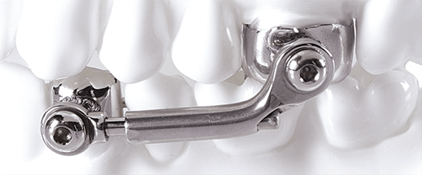 Herbst Orthodontic Appliance - DynaFlex