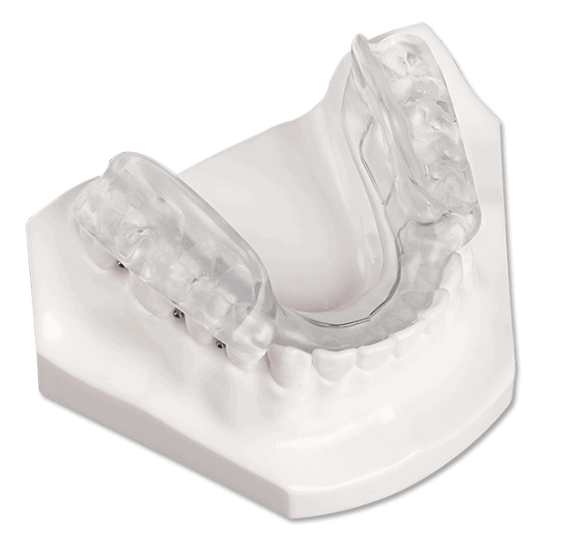 Removable Orthodontic Appliances - DynaFlex