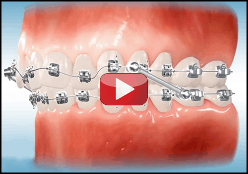 CS System Class II and Class III Corrector - DynaFlex