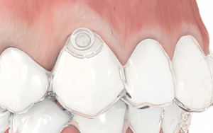 EZ-Align - Precision Aligner Buttons - DynaFlex