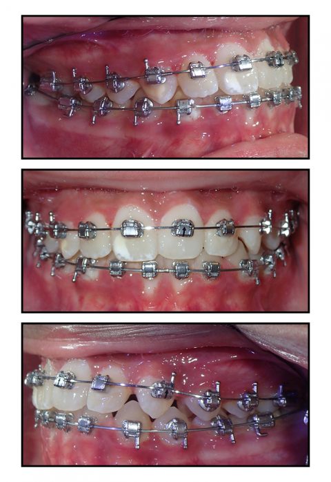 The Norris System - DynaFlex