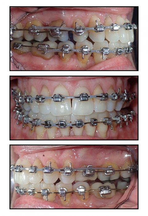 The Norris System - DynaFlex