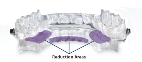 Custom Milled Devices - DynaFlex