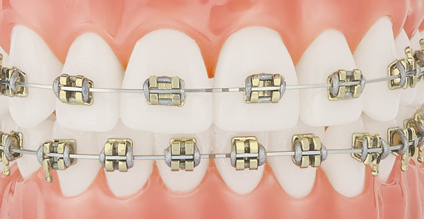 Atlas Mini Bracket System - DynaFlex